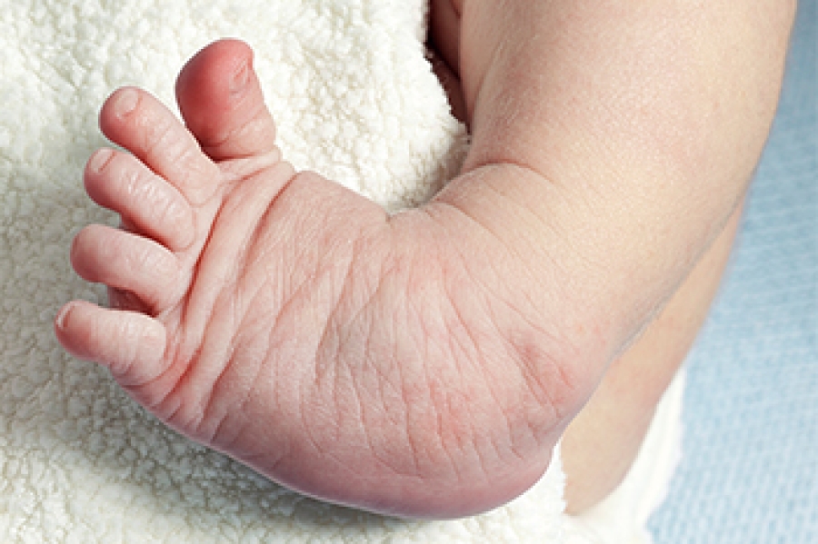 Common Foot Deformities in Babies